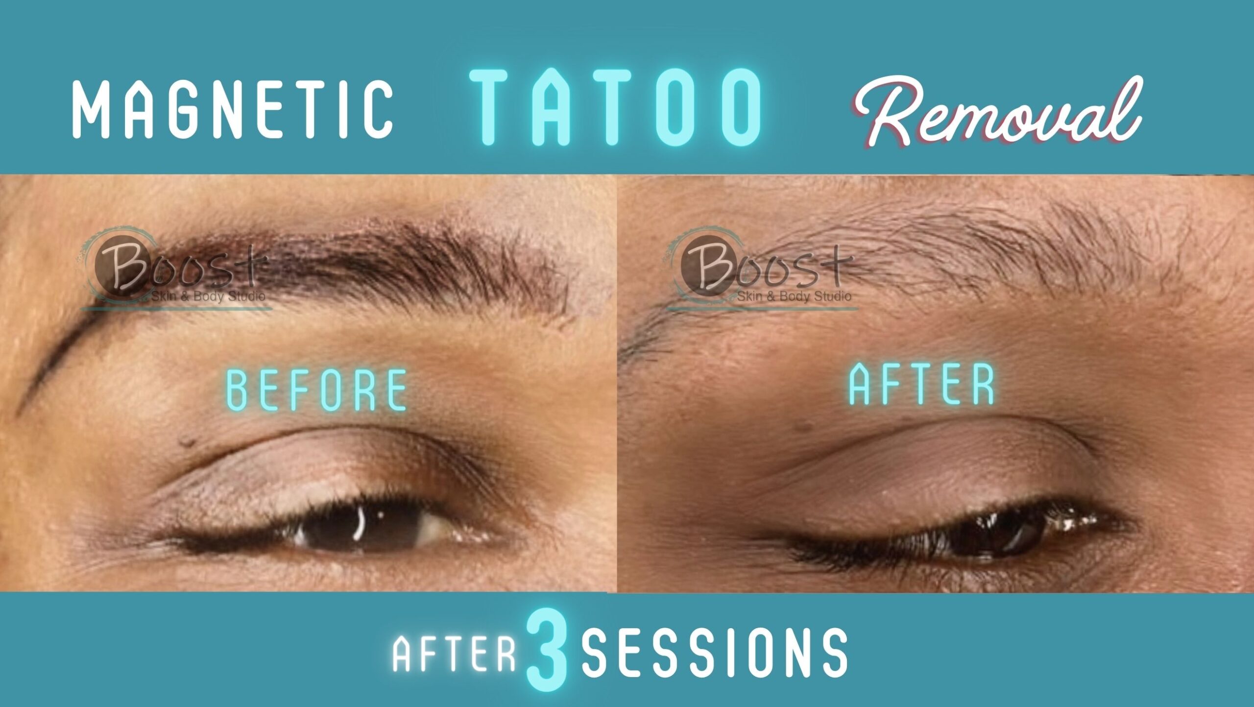 Magnetic Tattoo Removal | Boost Skin & Body Raleigh