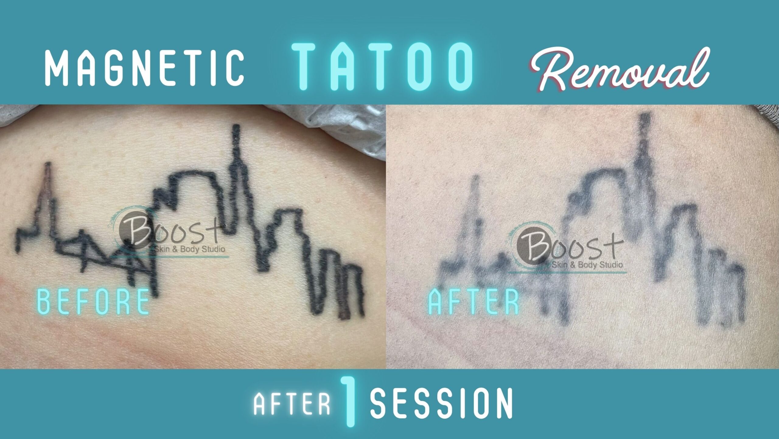 Magnetic Tattoo Removal | Boost Skin & Body Raleigh